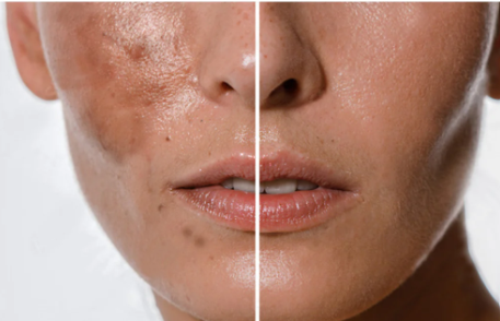 Hyperpigmentation & Dark Spots – SOIL & SKIN